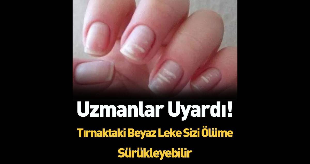 Tırnaktaki beyaz leke
